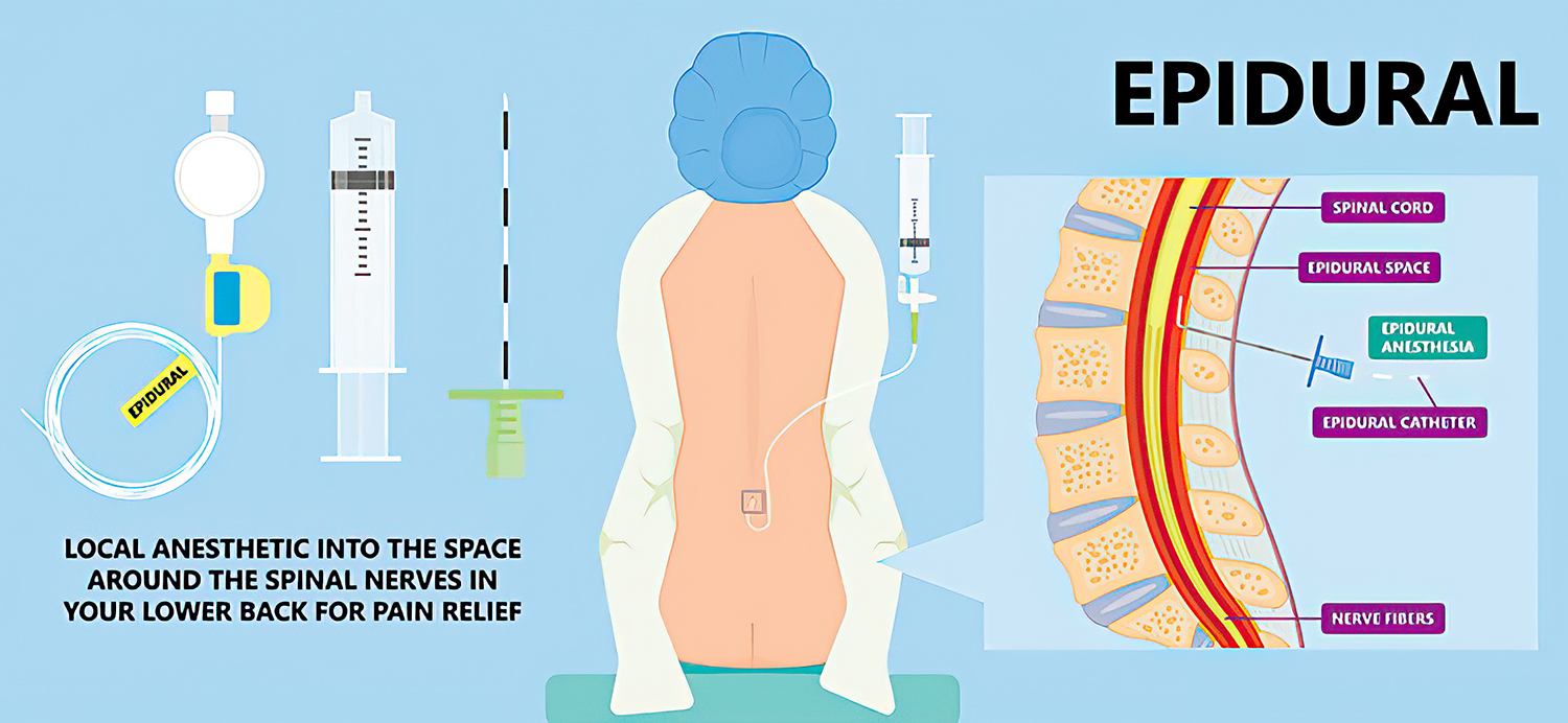 Epidural Injections TriMed Spine Joint