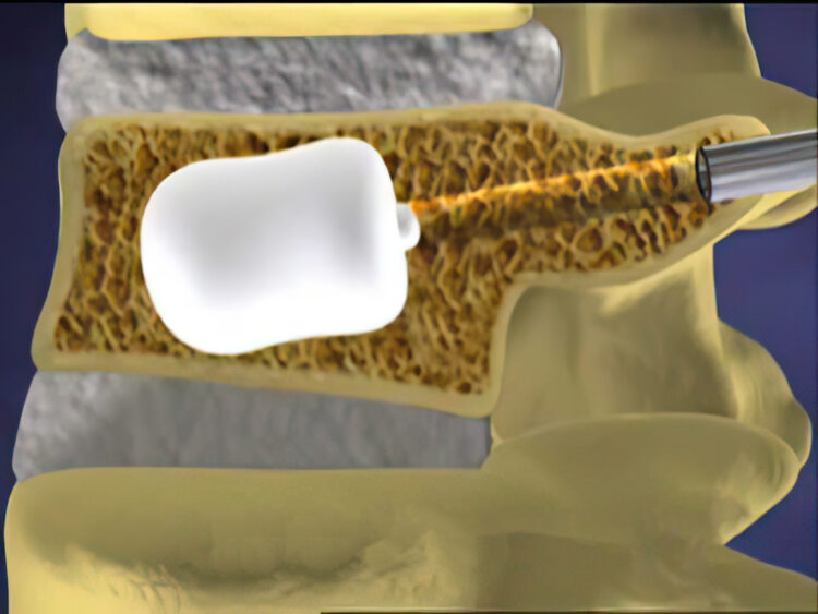 Vertebral Kyphoplasty - TriMed Spine & Joint