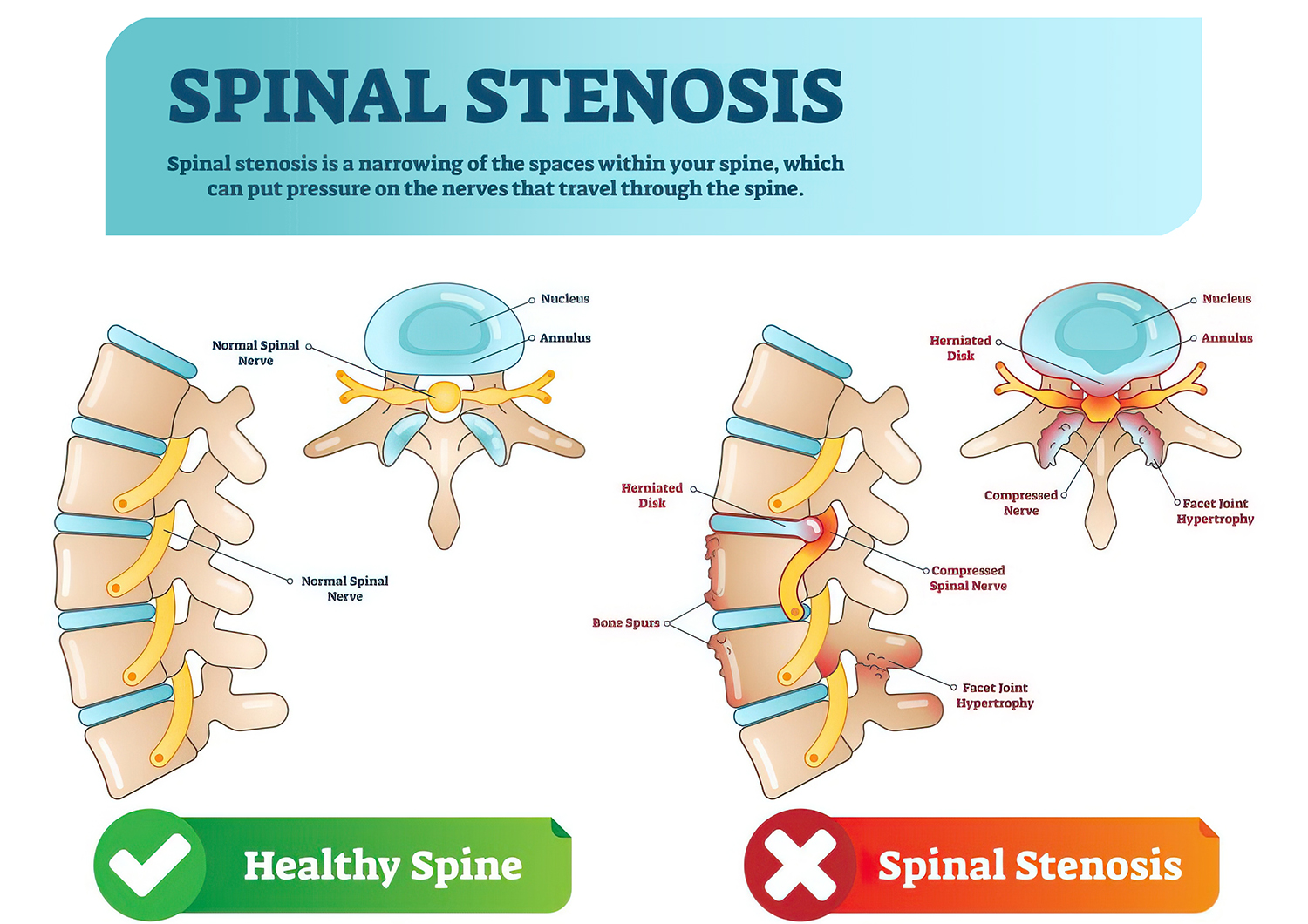 Cervical Stenosis TriMed Spine Joint