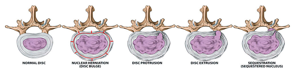 Herniated Disc - TriMed Spine & Joint