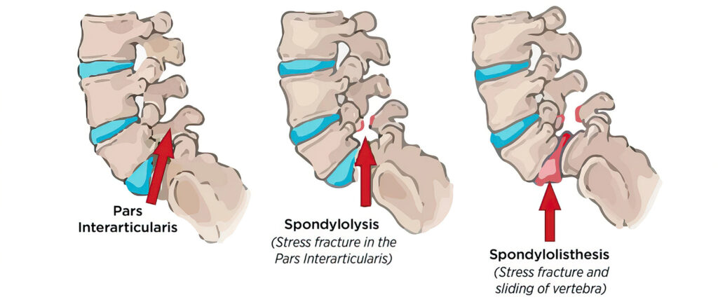 Spondylolisthesis - TriMed Spine & Joint