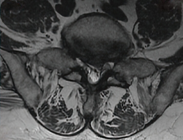 Herniated Disc - TriMed Spine & Joint